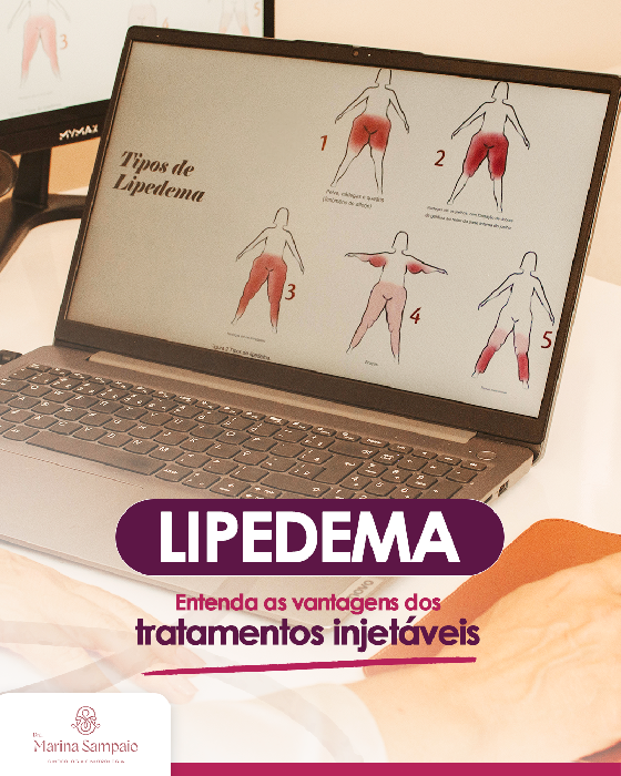 LIPEDEMA - Entenda as vantagens dos tratamentos injetáveis :: Dra ...